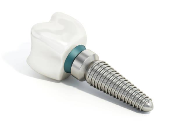 Top Facts Behind Fast Dental Implant Recovery